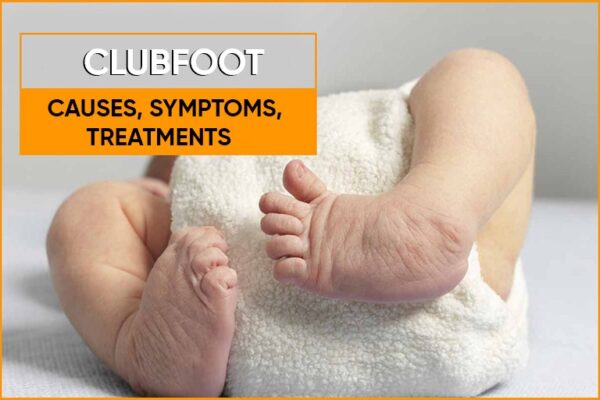 Causes, Symptoms, and Treatments of Clubfoot - OHC