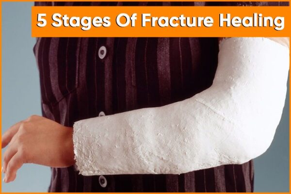 5 Stages of Fracture Healing - Orange Healthcare